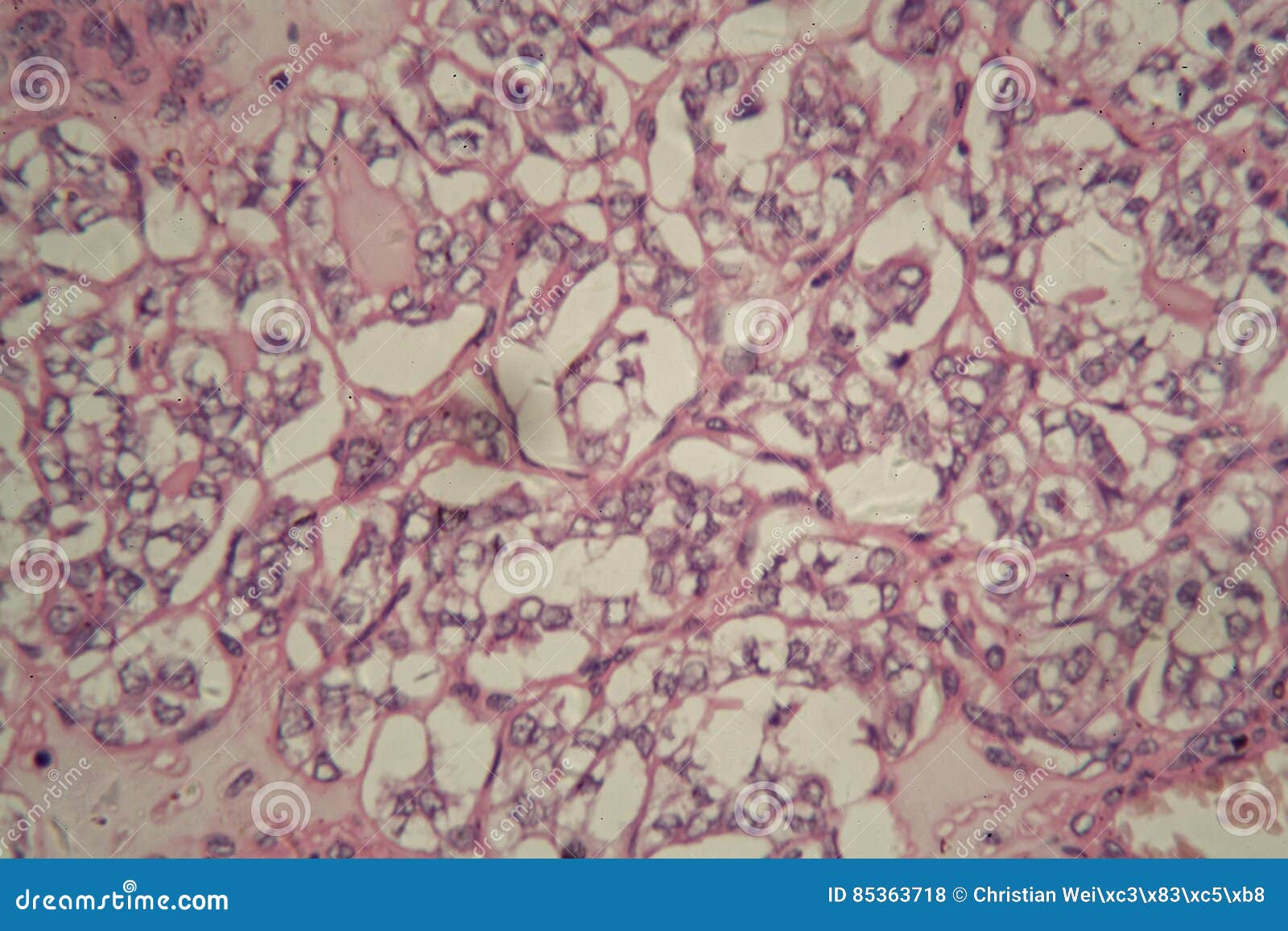 Thyroid Gland Cells with Cancer Stock Photo - Image of medical ...