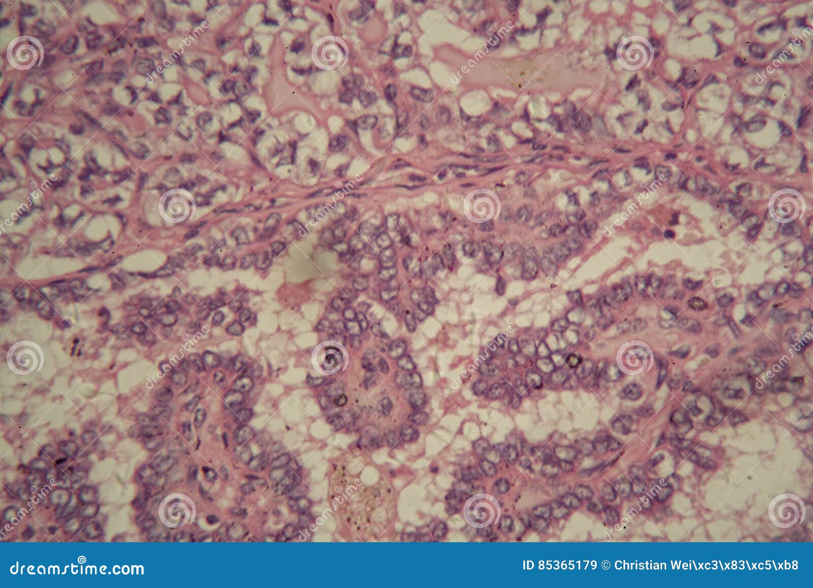 Thyroid Gland Cells With Cancer Stock Image Image Of Microscope Anatomy 85365179