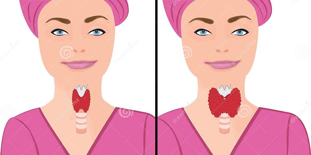 Thyroid Healthy And Enlarged Thyroid Hypothyroid Vector Illustration