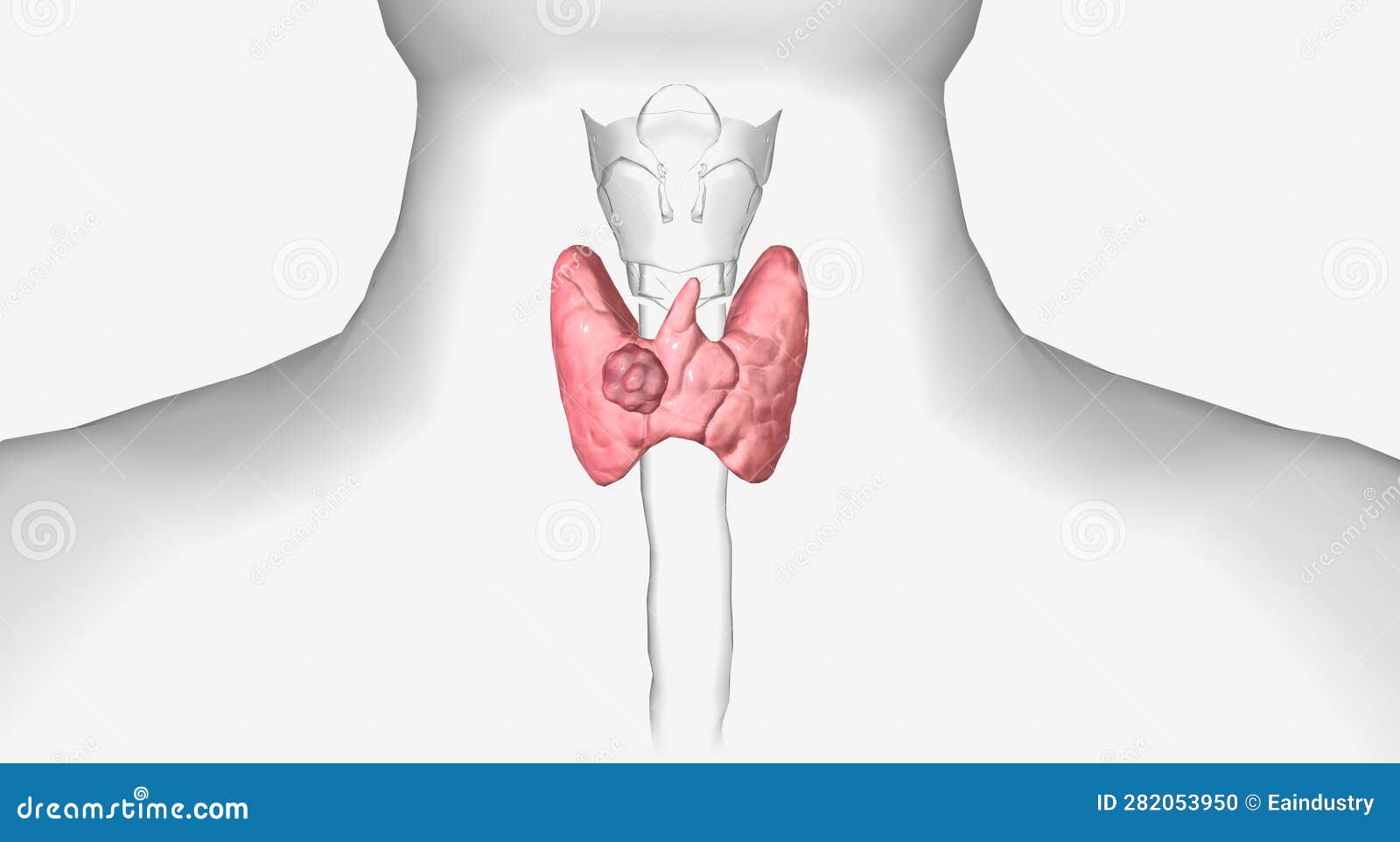 Thyroid Nodules Cartoon Vector | CartoonDealer.com #66909363