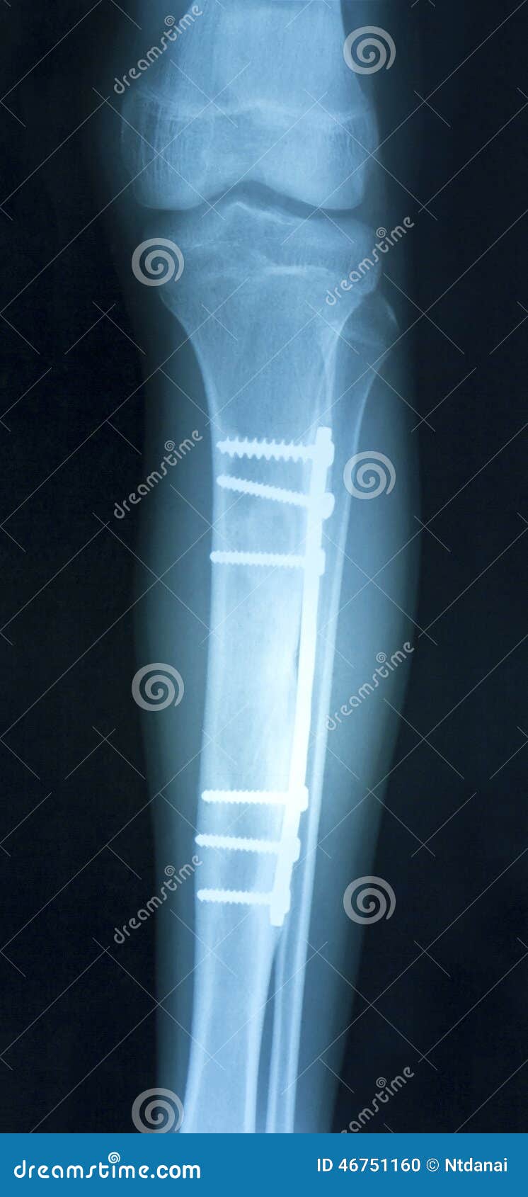 Tibia de rayon X de film photo stock. Image of accident - 46751160