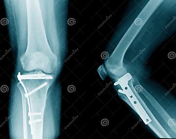 Tibia Fracture with Post Operation Internal Fixation Stock Photo ...