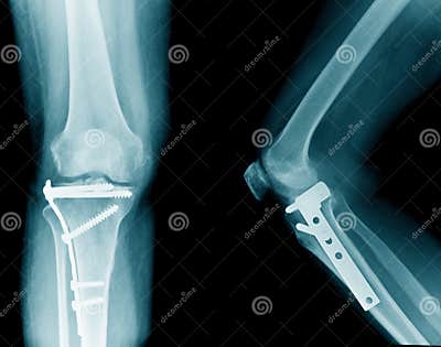 Tibia Fracture with Post Operation Internal Fixation Stock Photo ...
