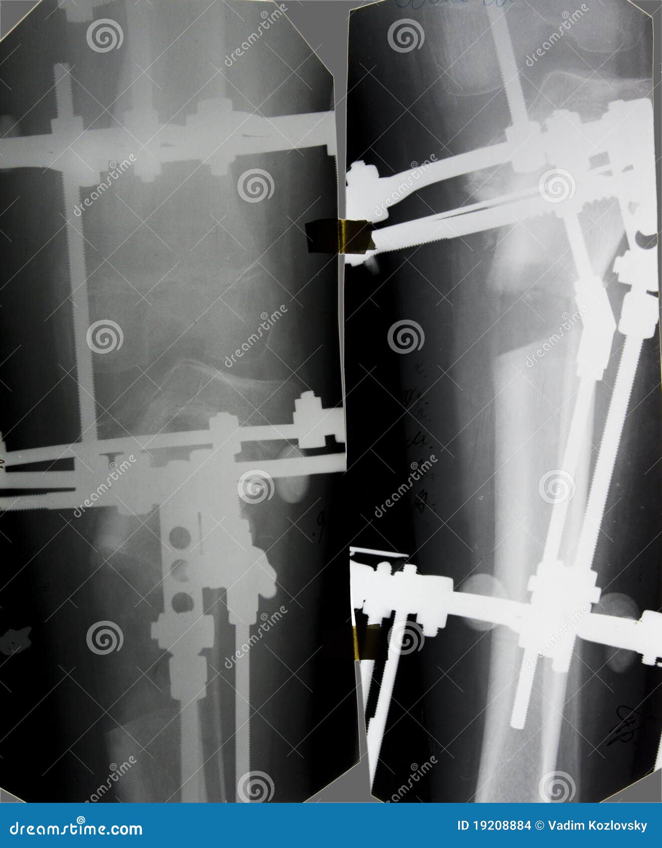 Tibia X-ray Picture Royalty-Free Stock Image | CartoonDealer.com #19208884