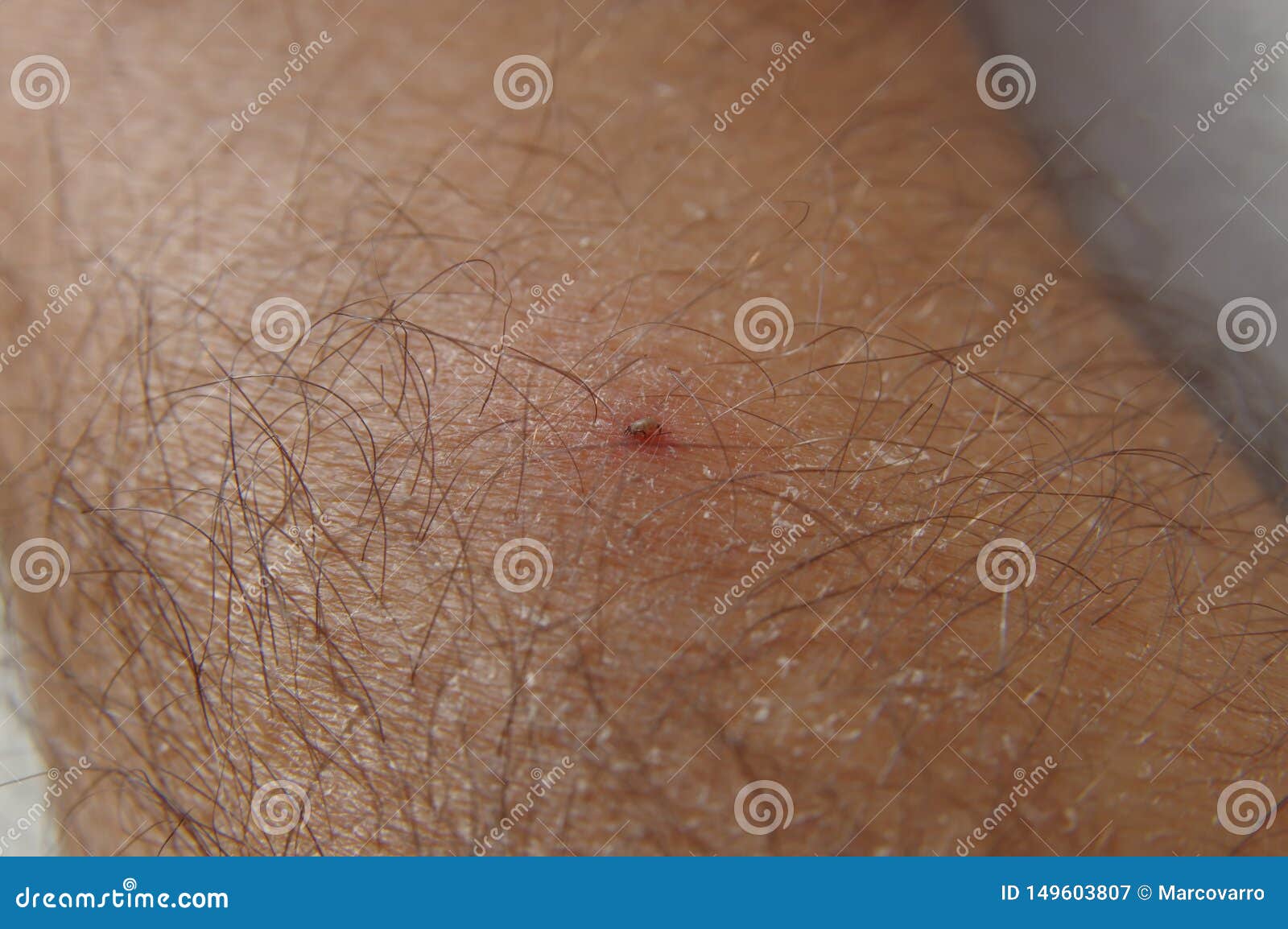 Tick bite arm stock image. Image of encephalitis, design - 149603807
