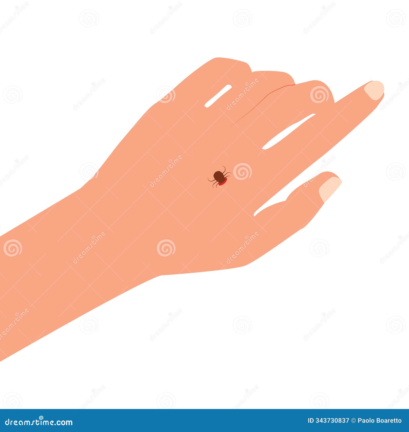 Tick ??bite. Tick on a Human S Hand. Healthcare Illustration Stock ...