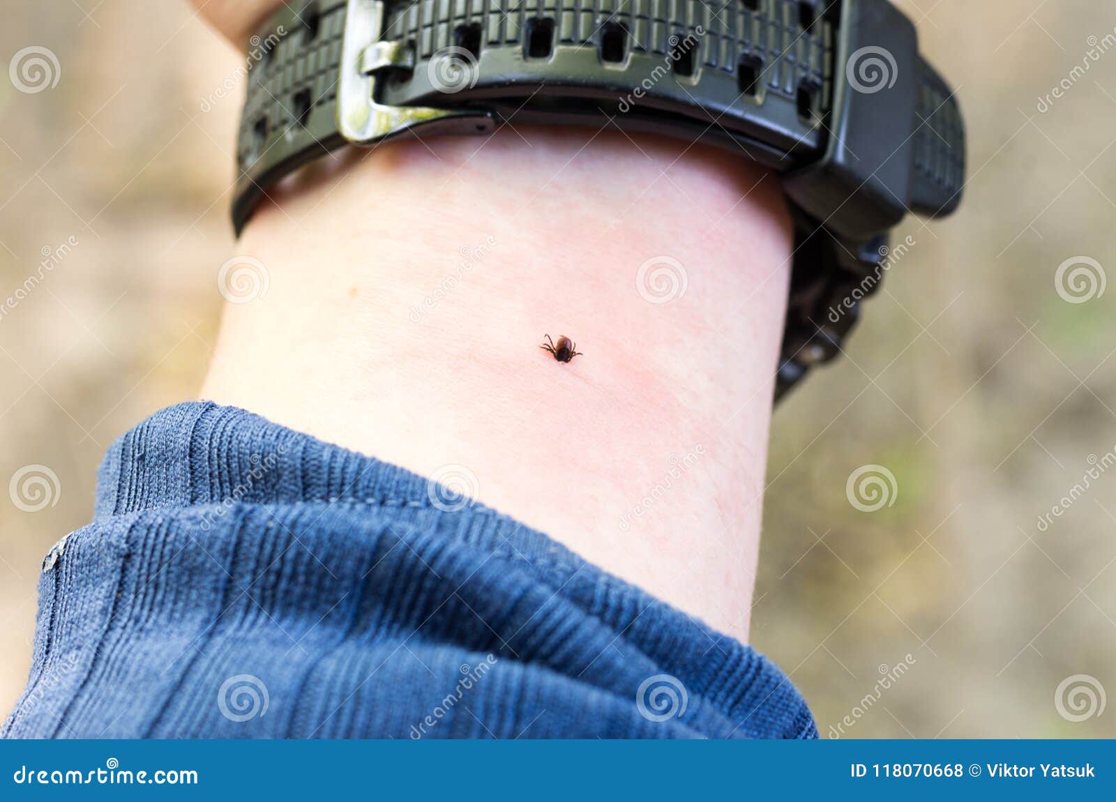 The Tick Bites His Hand. Mite Under The Skin. The Hand Of Man. Royalty ...