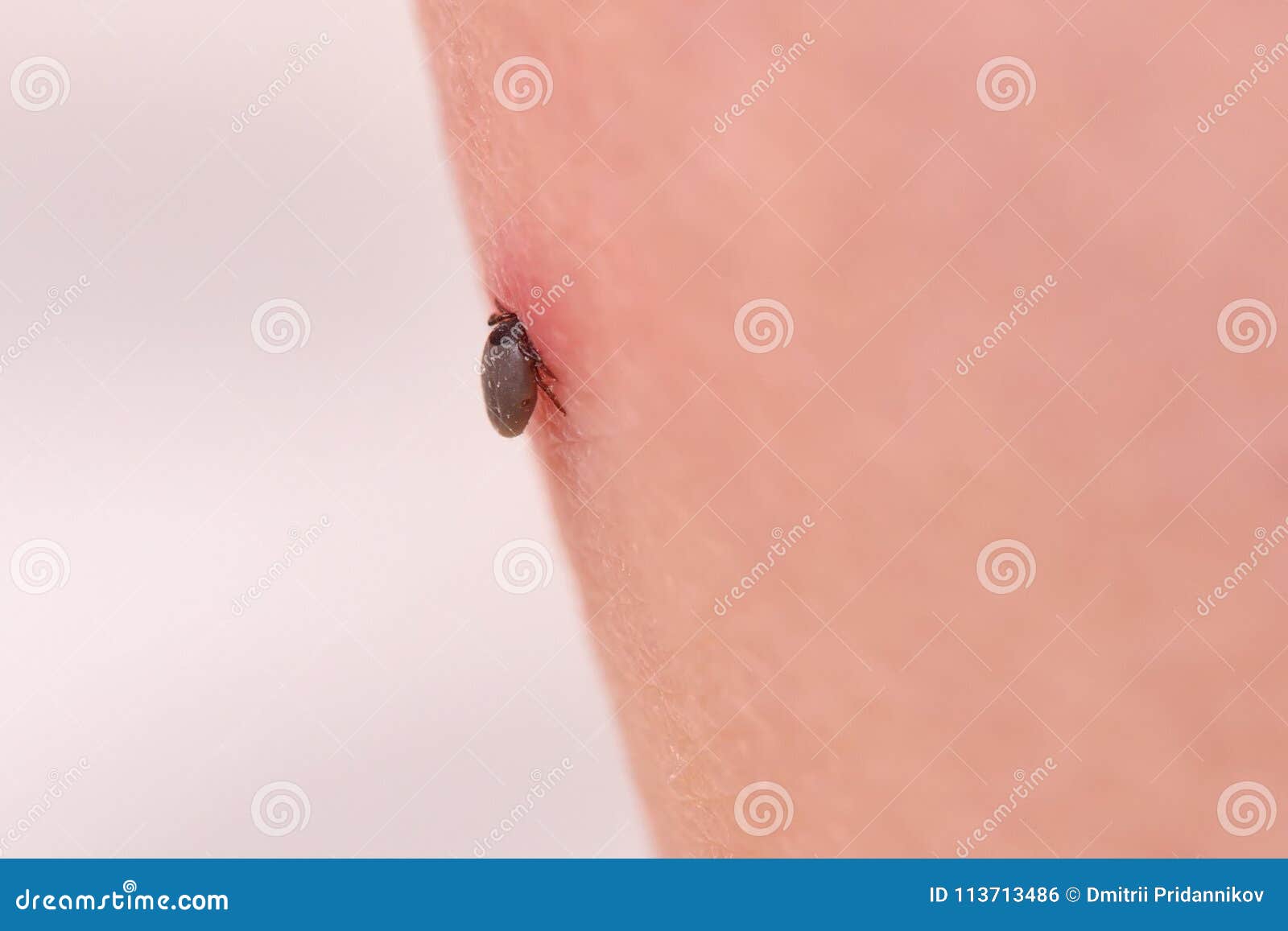Tick Bite Stock Photos - Royalty Free Images - Page 2