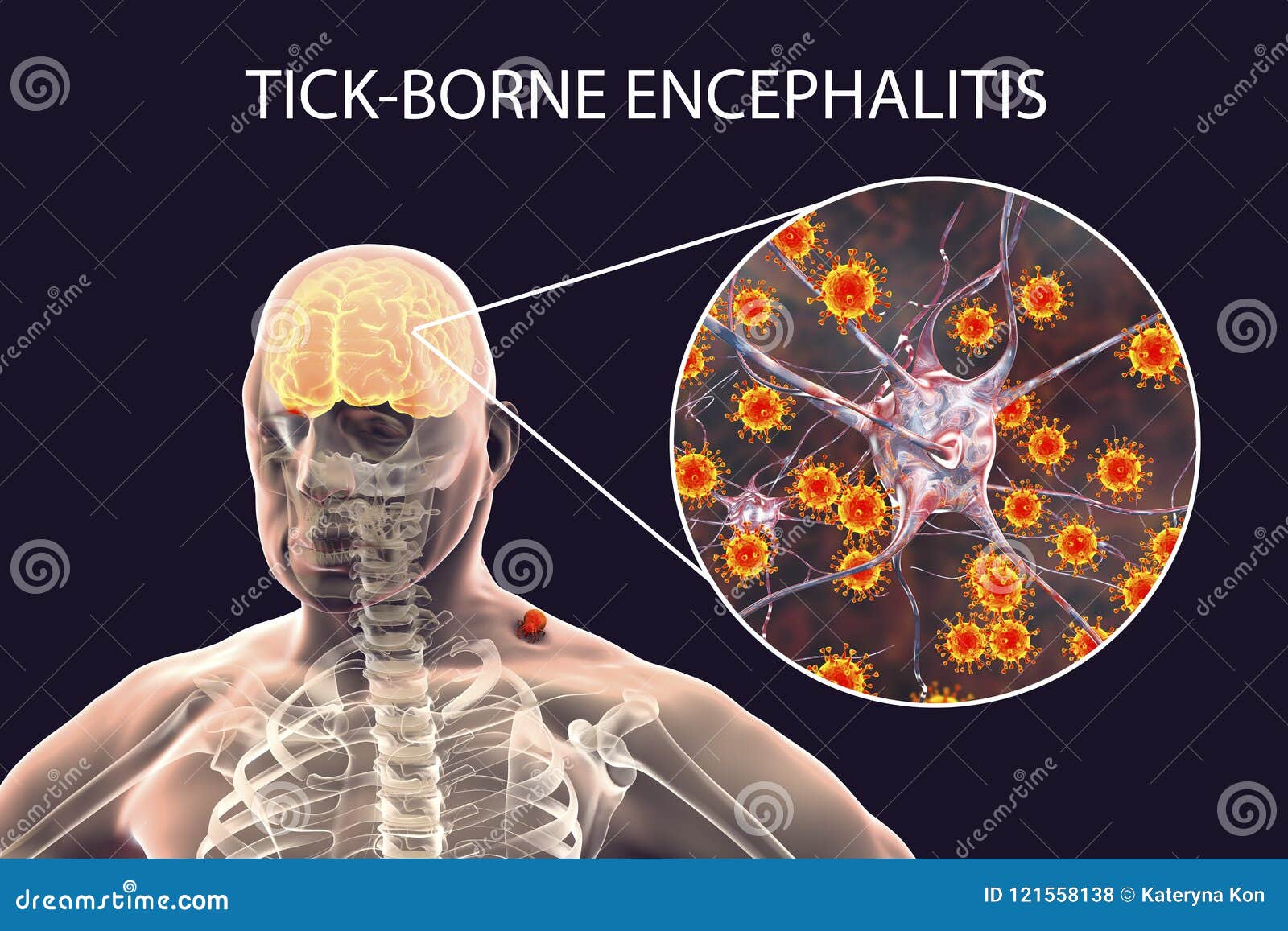Tick-borne Encephalitis Concept Stock Illustration - Illustration of ... Tick-borne Encephalitis Concept Stock Illustration - Illustration of ...