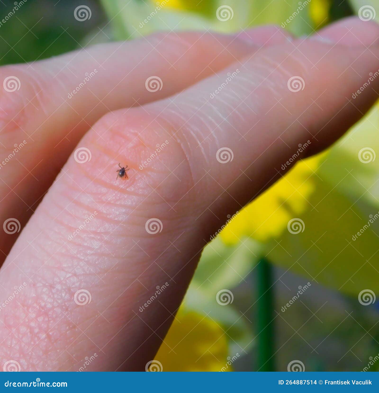 A Tick Crawls Palm Up On A Hand Close-up. Horizontal Orientation. Stock ...