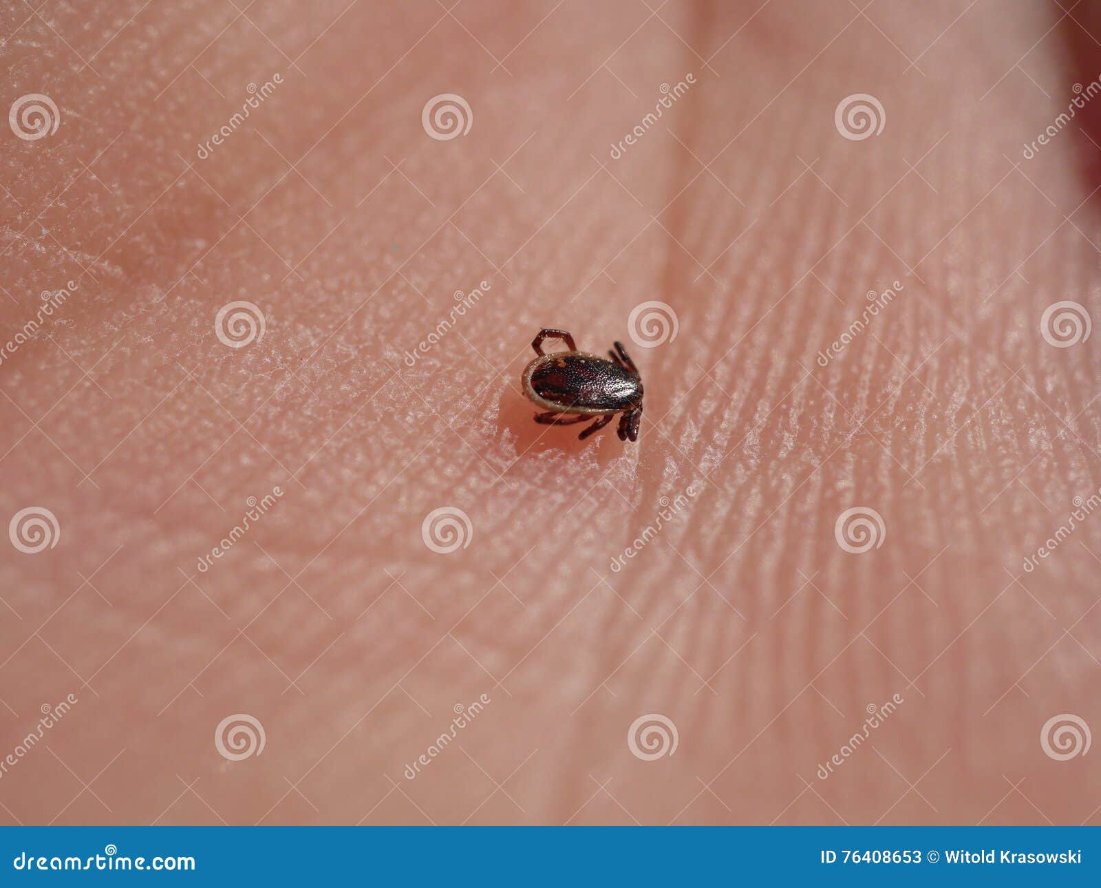 Tick stock image. Image of cerebral, tick, borreliosis - 76408653