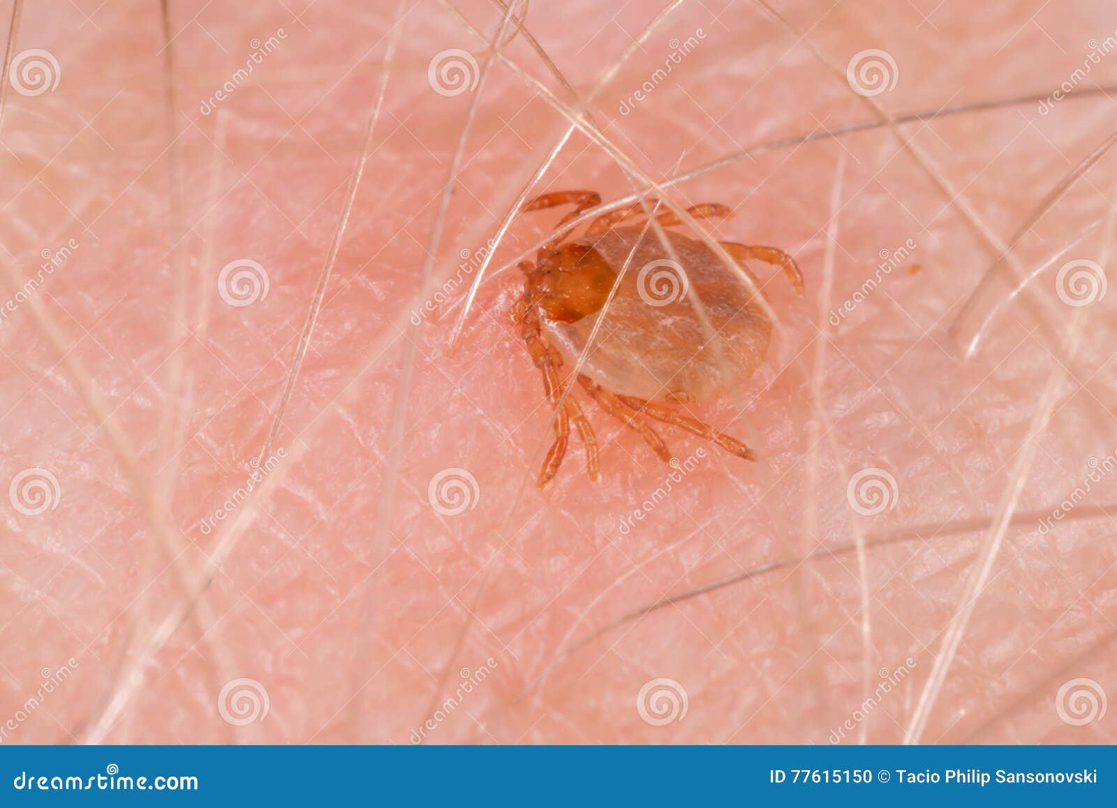Tick drinking blood stock photo. Image of hospital, ehrlichiosis - 77615150