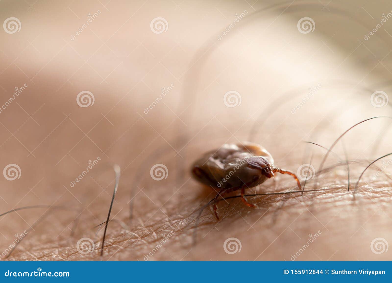 Tick Filled With Blood Sitting On Human Skin Stock Photography ...