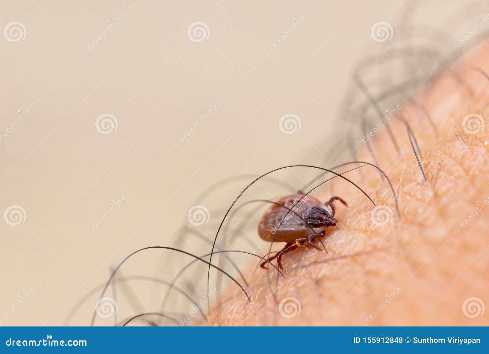 Tick Filled With Blood On Human Skin Royalty-Free Stock Photography ...
