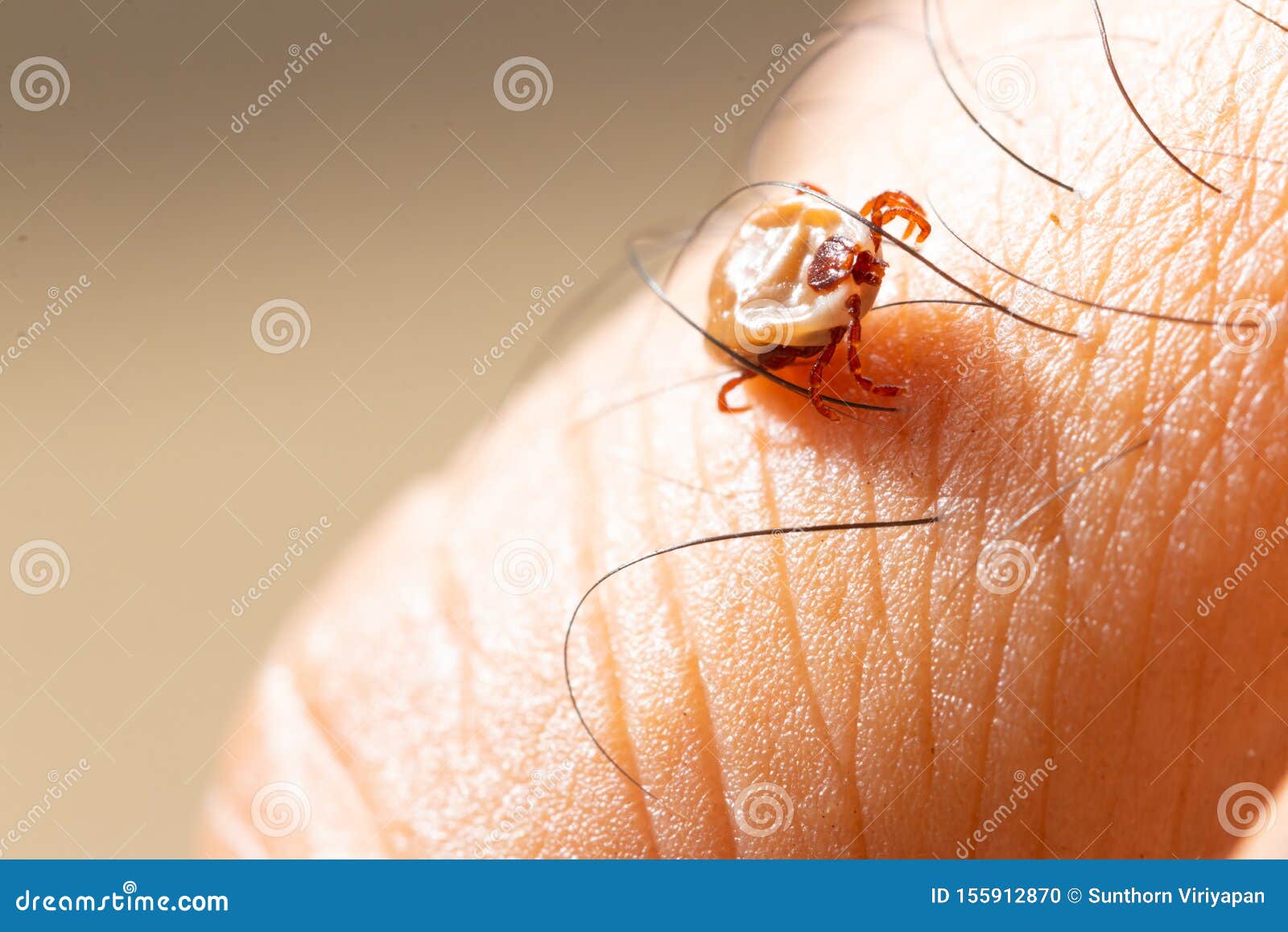 Tick Filled with Blood on Human Skin Stock Photo - Image of ...