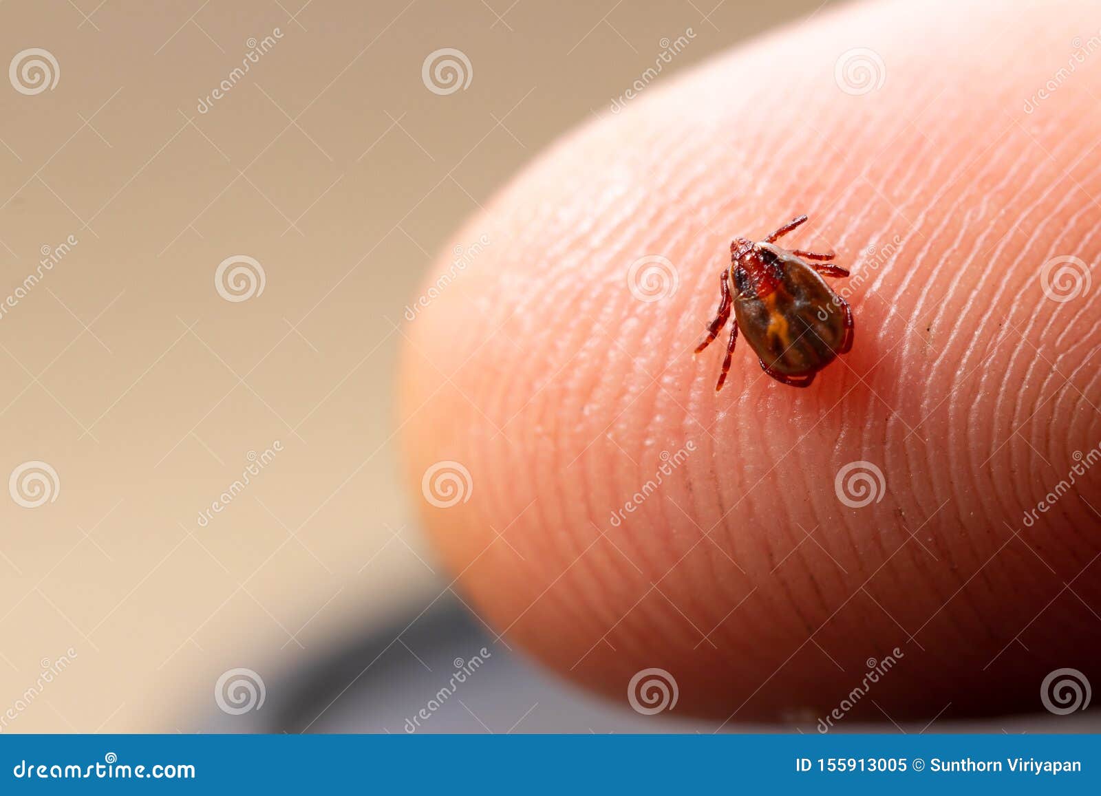 Tick Filled with Blood on Human Skin Stock Image - Image of animal ...