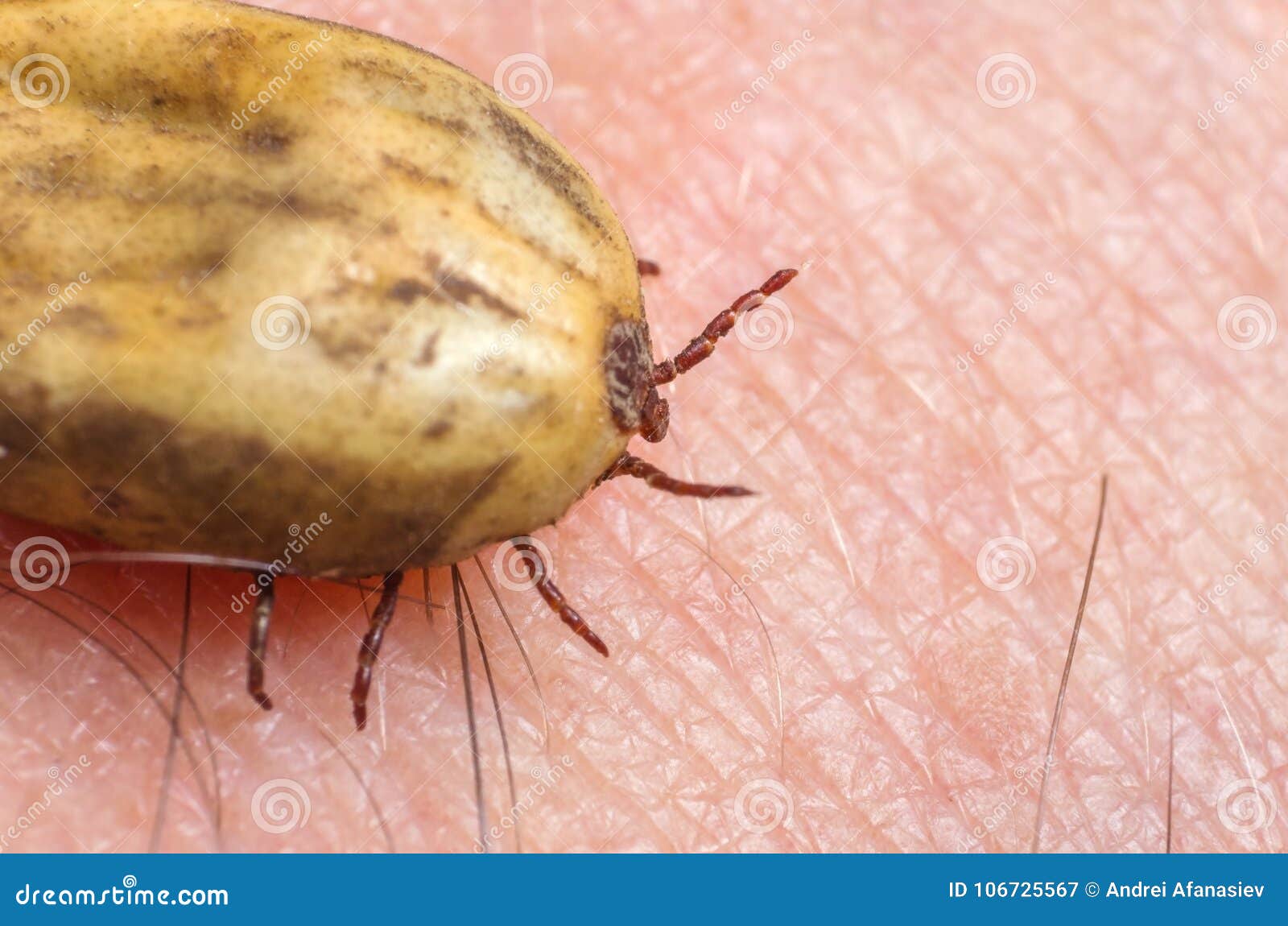 Tick Filled with Blood Sitting on Human Skin Stock Image - Image of ...
