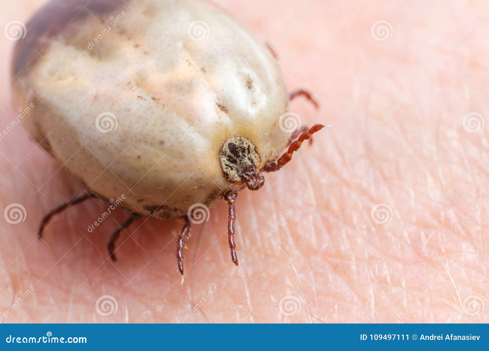 Tick Filled with Blood Sitting on Human Skin Stock Image - Image of ...