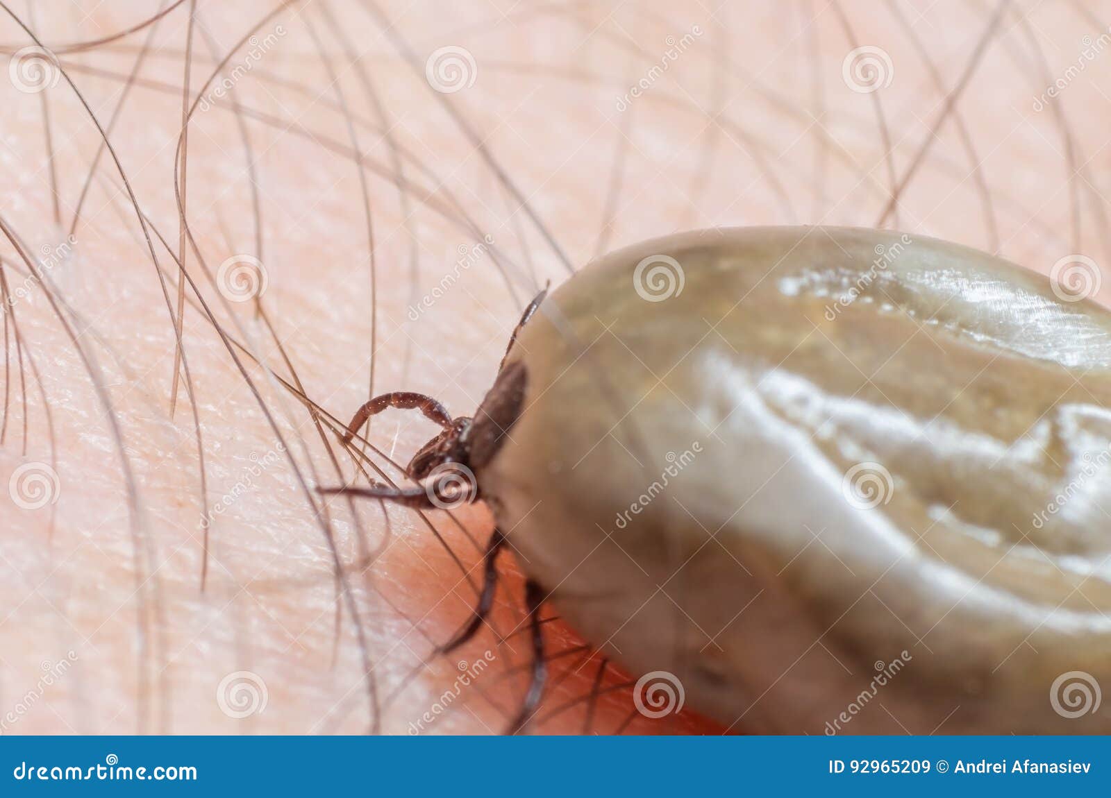 Tick Filled with Blood Sitting on Human Skin Stock Image - Image of ...