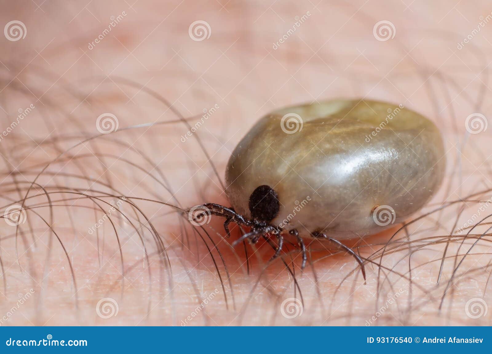 Tick Filled With Blood Sitting On Human Skin Stock Photography ...