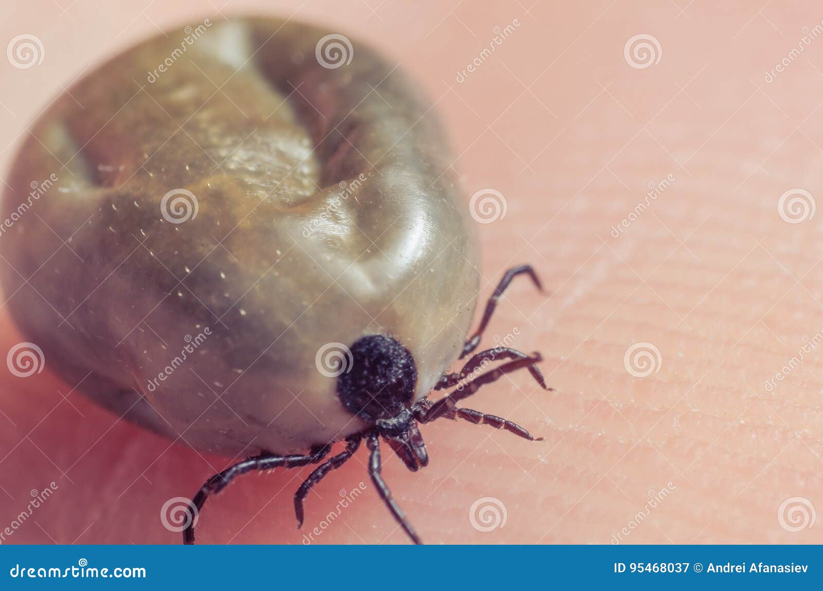 Tick Filled with Blood Sitting on Human Skin Stock Image - Image of ...