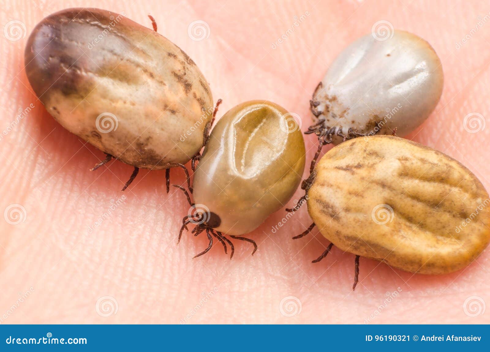 Tick Filled with Blood Sitting on Human Skin Stock Image - Image of ...