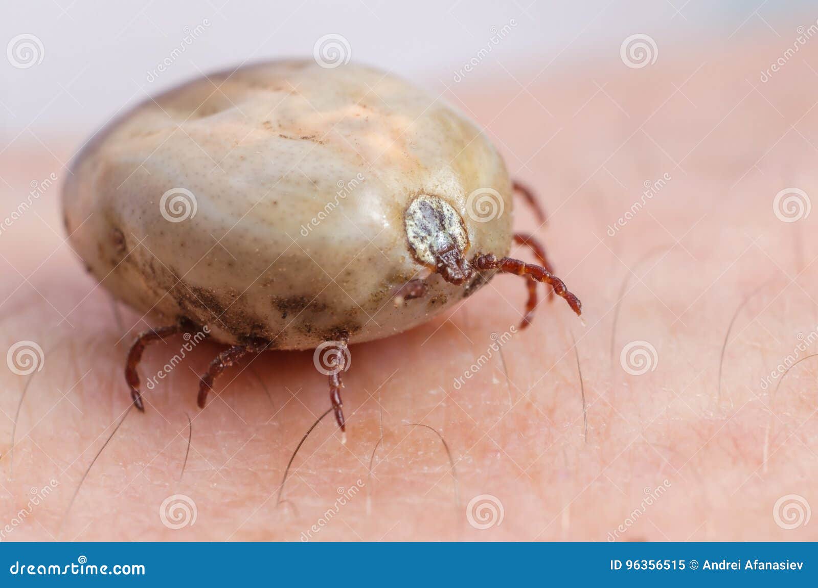 Tick Filled with Blood Sitting on Human Skin Stock Image - Image of ...