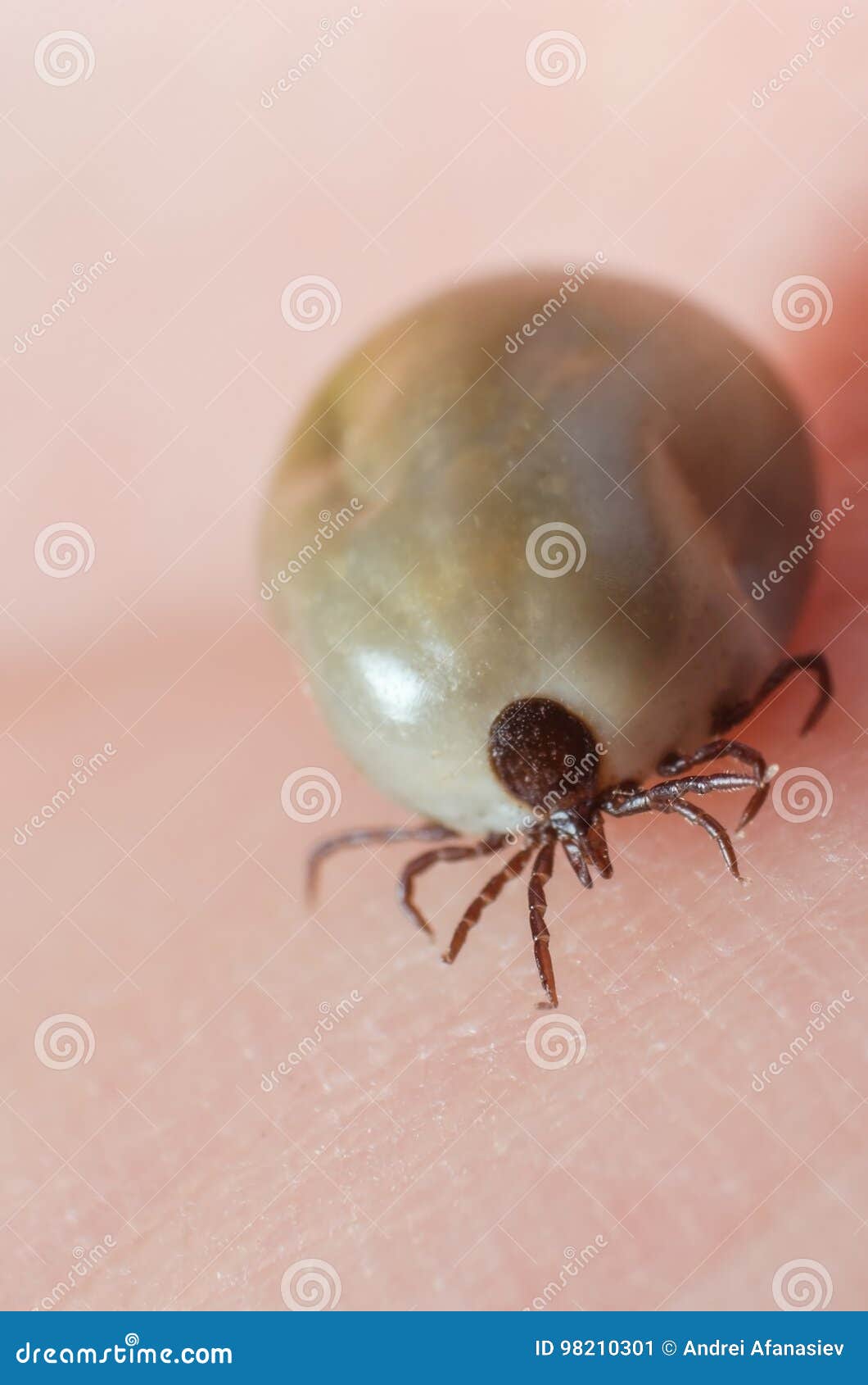 Tick Filled with Blood Sitting on Human Skin Stock Image - Image of ...