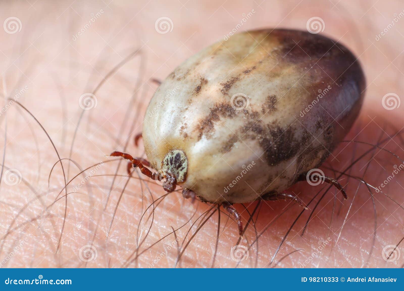Tick Filled with Blood Sitting on Human Skin Stock Image - Image of ...