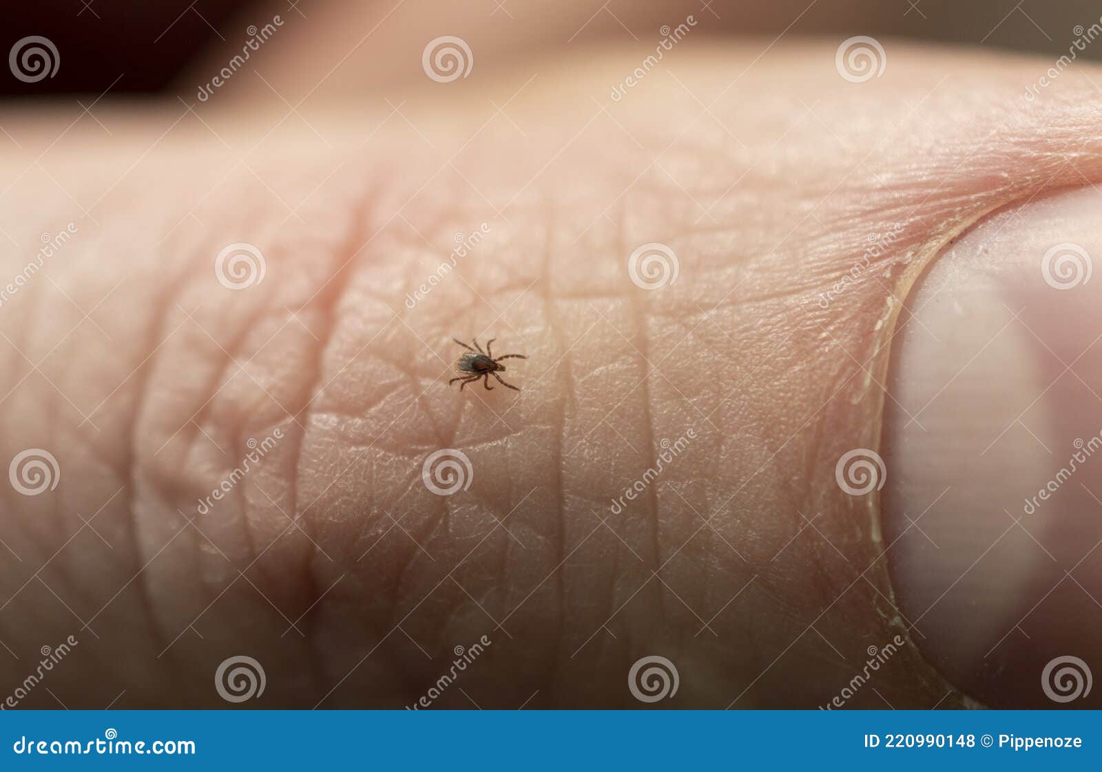 Tick On Human Skin. Carrier Of Infections Of Encephalitis. Parasite ...