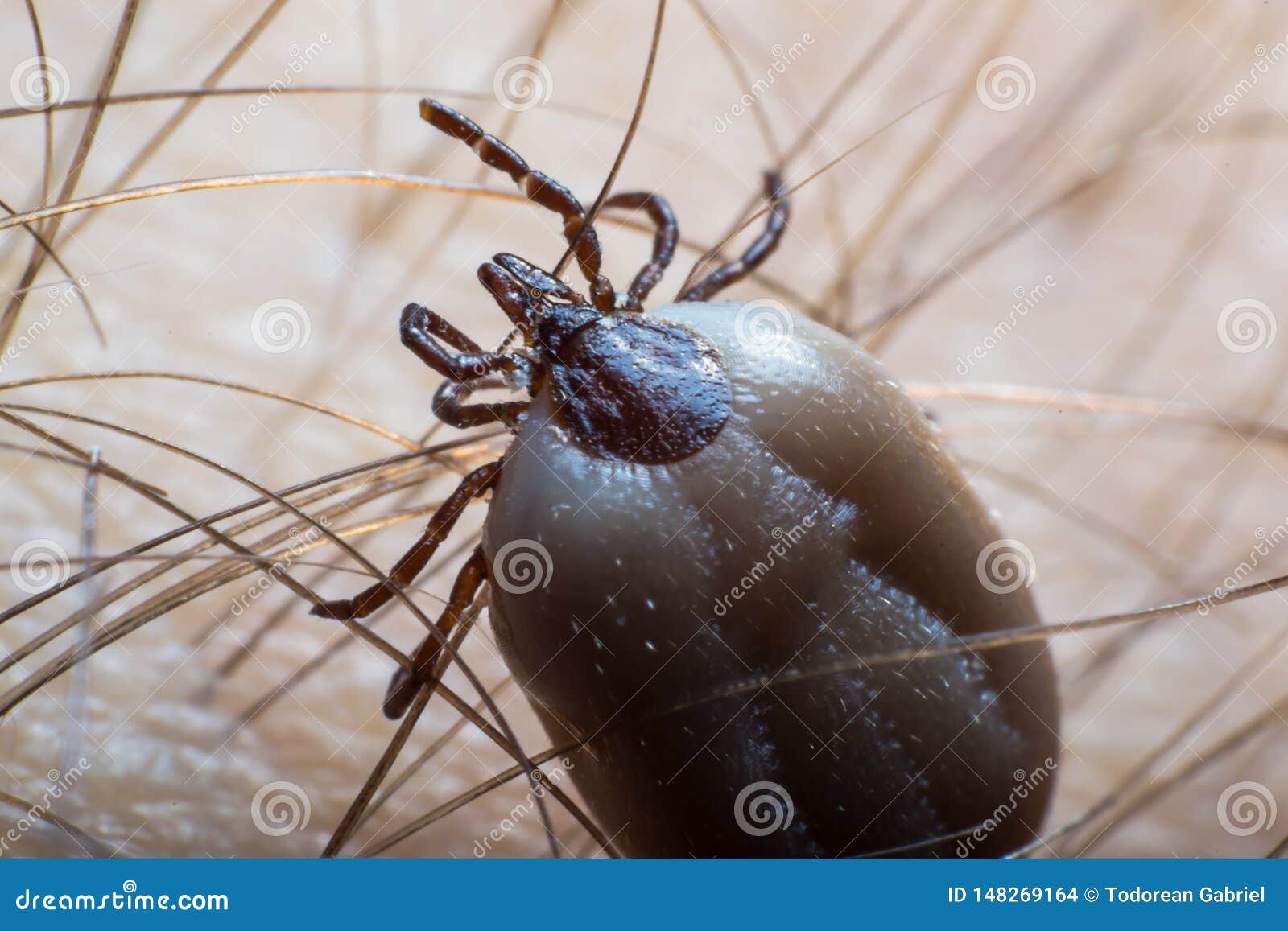 Tick on the Human Skin Surface Stock Photo - Image of fever, infection ...