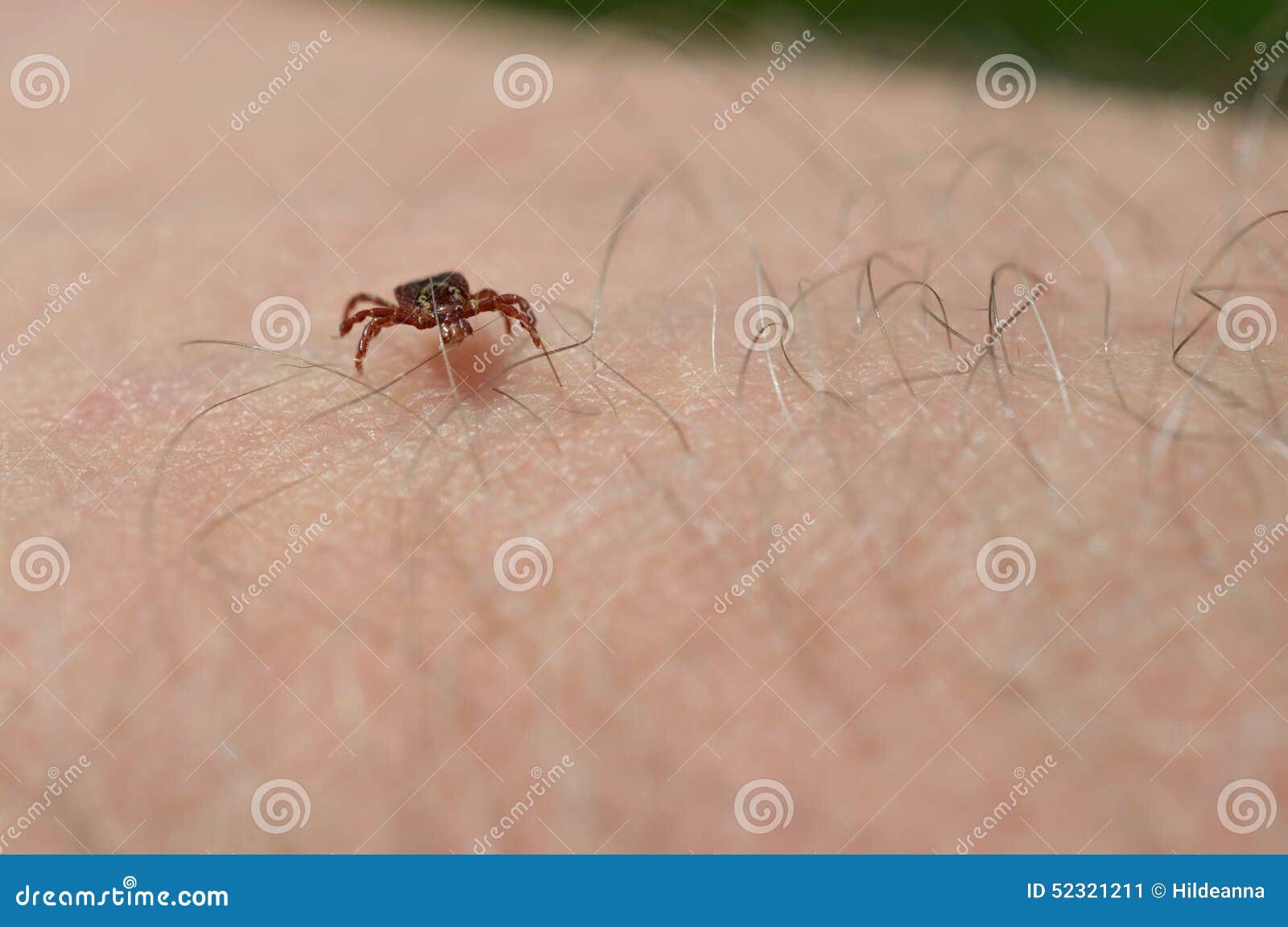 Tick on mans arm stock image. Image of summer, bite, sucking - 52321211