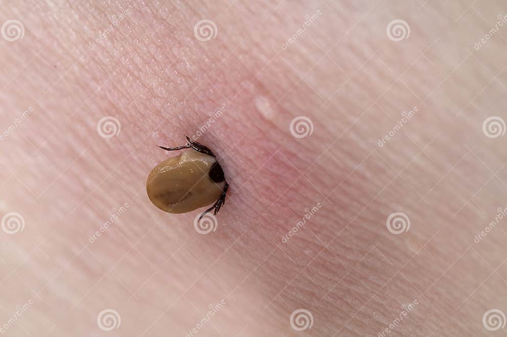 Tick stuck in the skin stock photo. Image of disease - 22123282