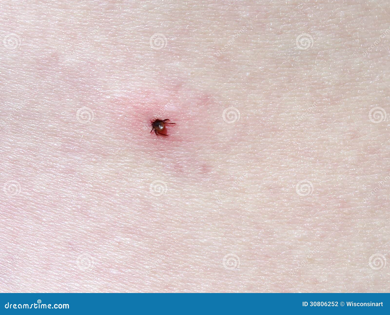 Tik, Insect, Insectenbeet, Parasiet Stock Foto - Image of slecht, eten ...