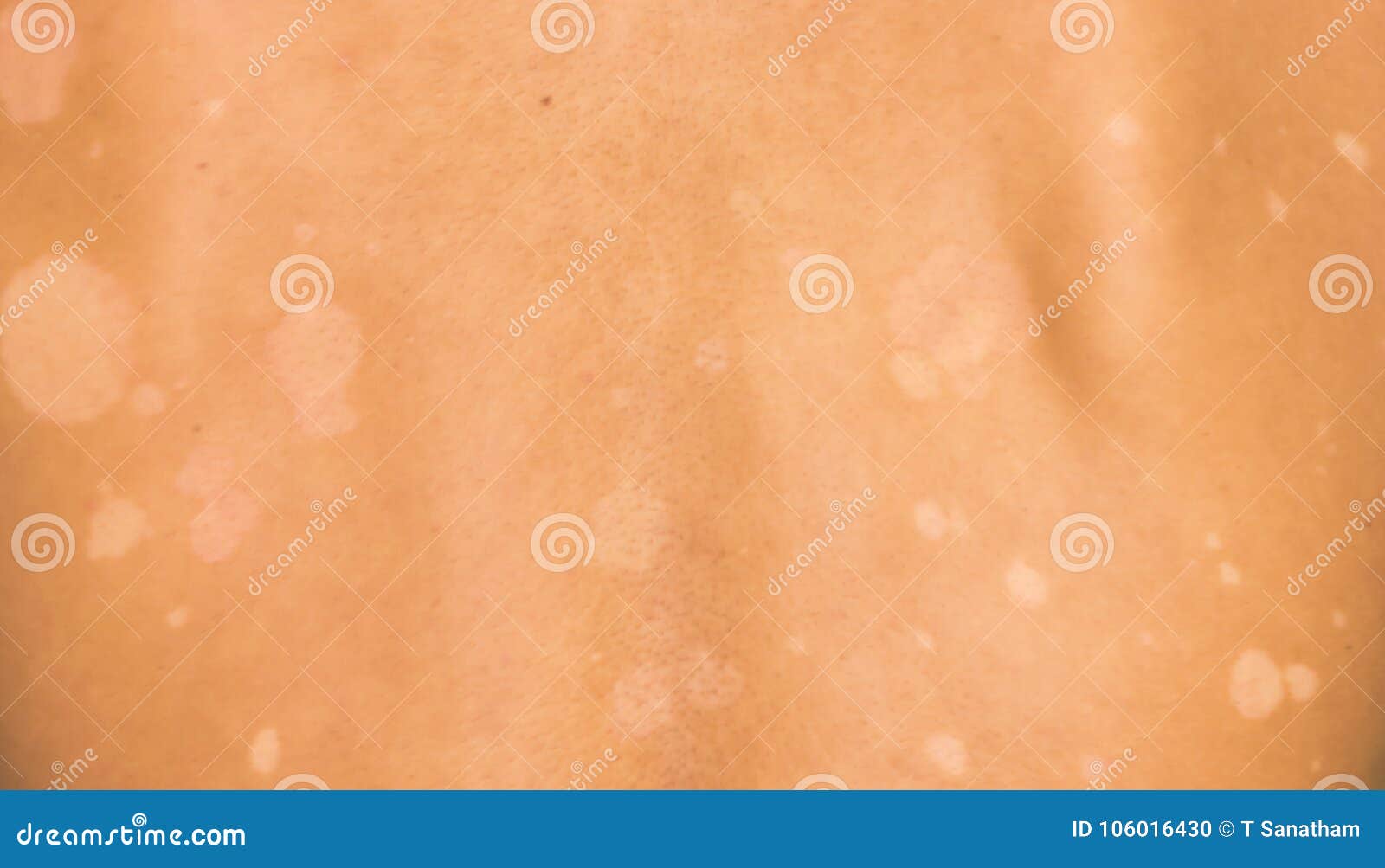 Tinea is the Back Plate is Expanding. Stock Photo - Image of ...