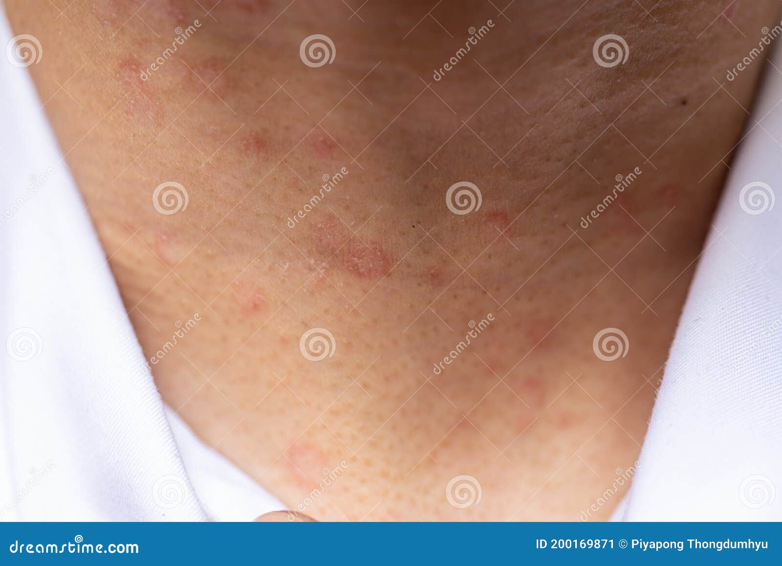 Tinea Circinata or Ringworm . Stock Image - Image of fungal, circinata ...