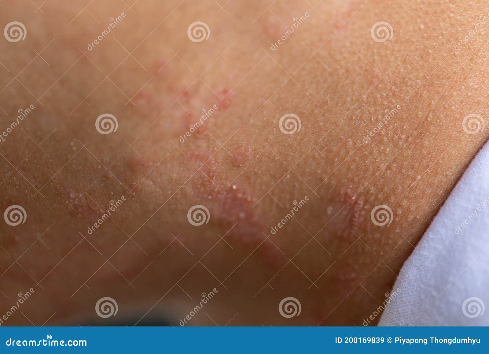 Tinea Circinata or Ringworm . Stock Image - Image of care, circinata ...