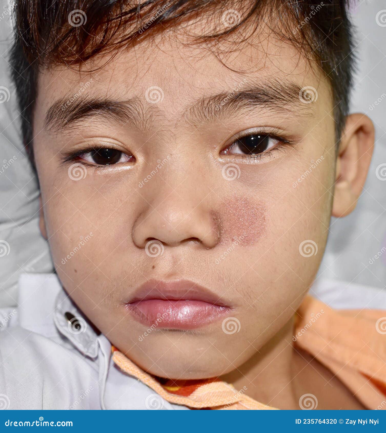 Tinea Infection At Scalp It Is A Fungal Infection That Causes Scaly And Itching Royalty Free