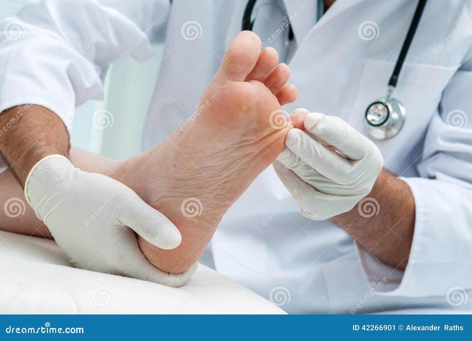 Tinia Pedis Lub Atlety Stopa Obraz Stock - Obraz złożonej z grzyb ...