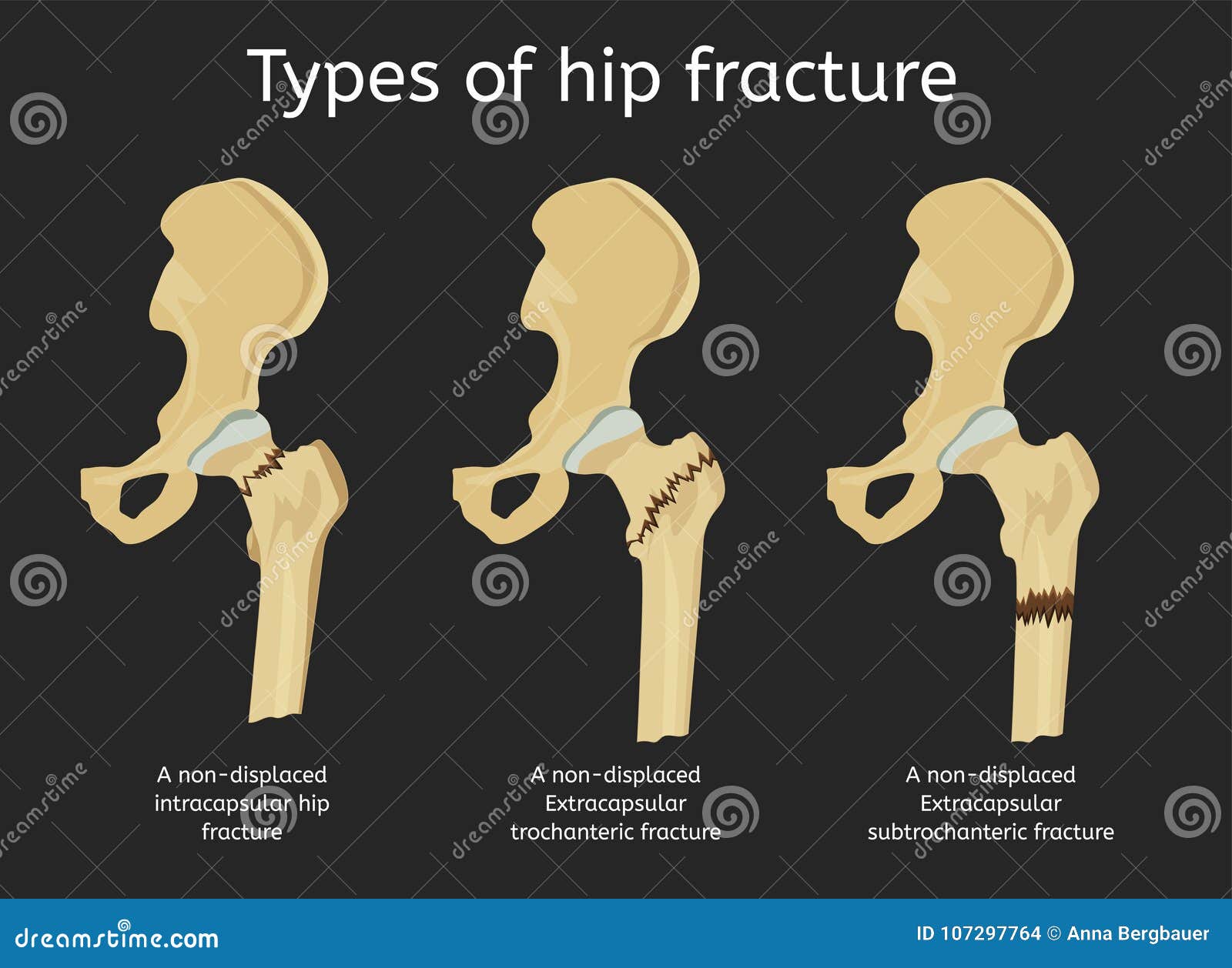 Tipos de fratura anca ilustração do vetor. Ilustração de ortopédico ...