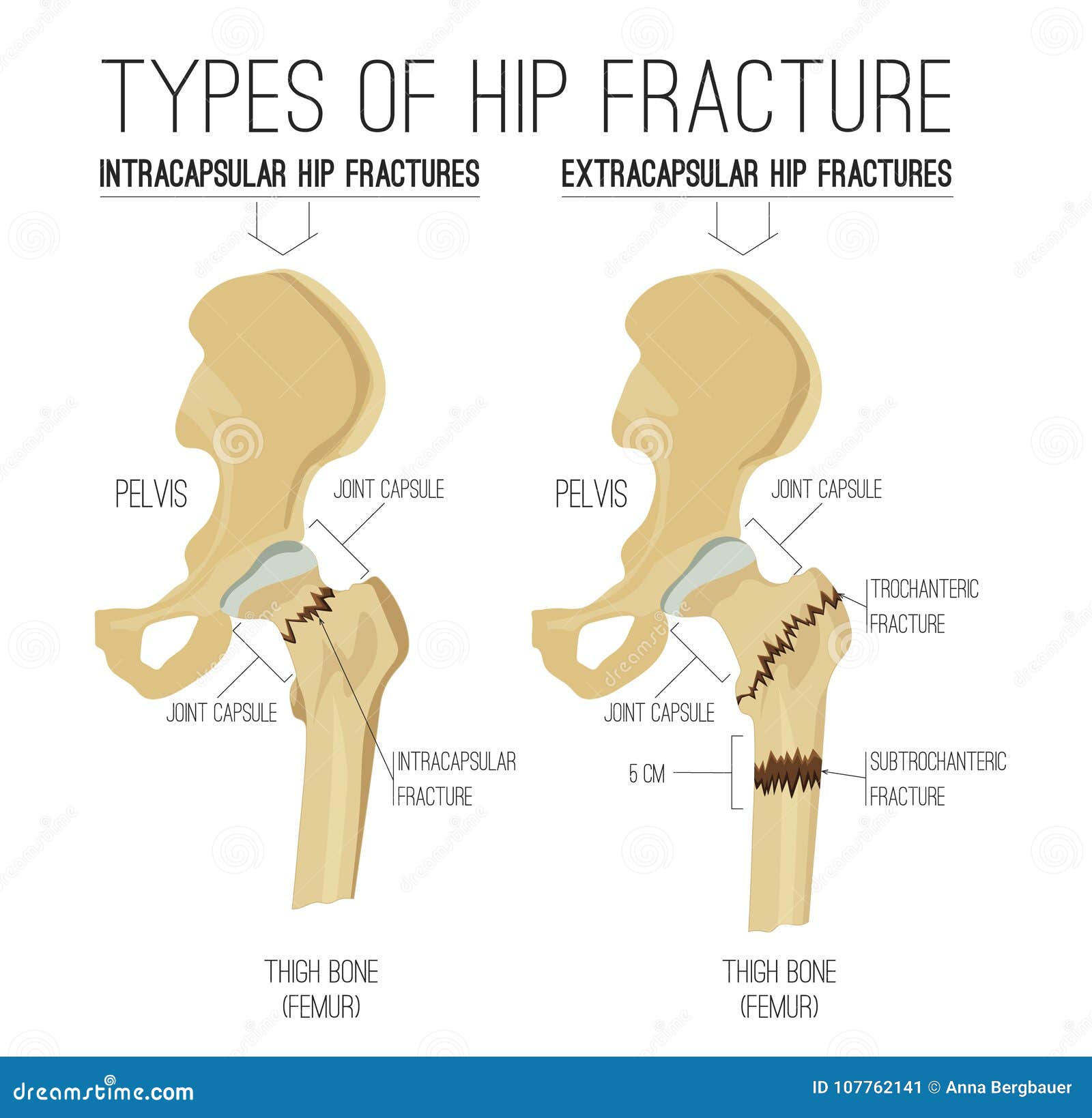 Tipos de fratura anca ilustração do vetor. Ilustração de biologia ...
