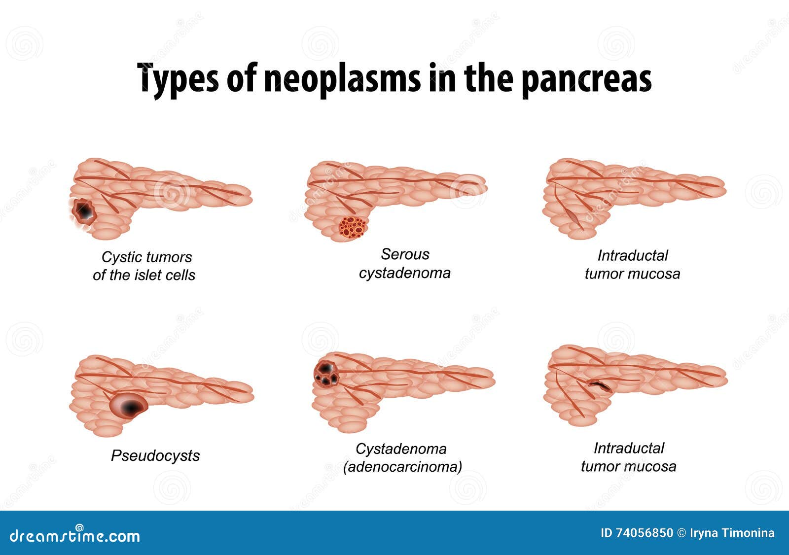 Tipos De Neoplasma No Pâncreas Infographics Ilustração do Vetor ...