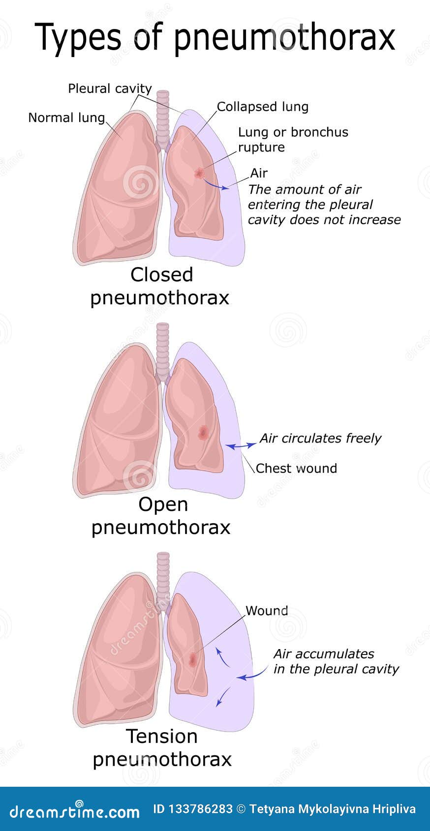 Tipos de neumotórax ilustración del vector. Ilustración de abierto ...