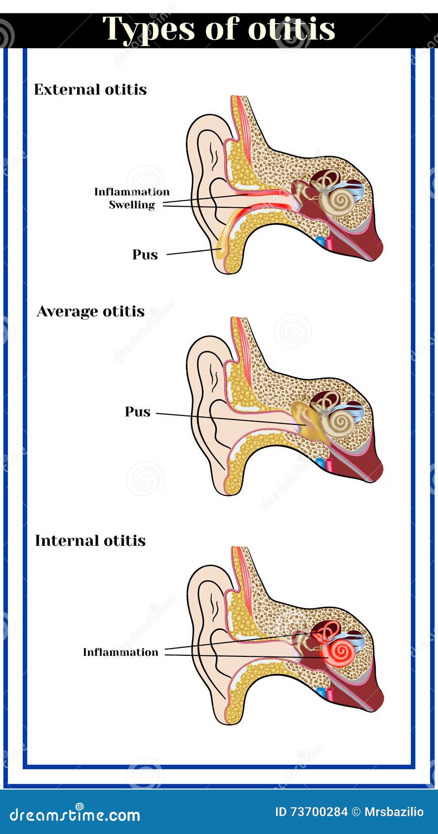 Tipos De Otitis: Otitis Del Externo, Medio E Interno Ilustración del ...