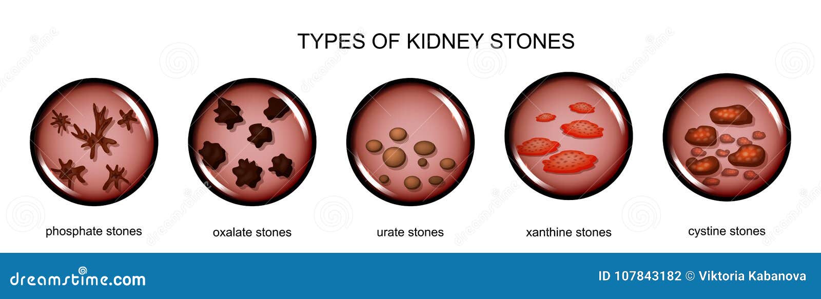 Tipos de pedras de rim ilustração do vetor. Ilustração de medicina ...