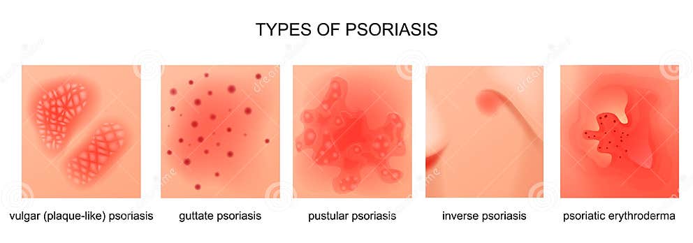 Tipos de psoriasis ilustración del vector. Ilustración de piel - 113492451