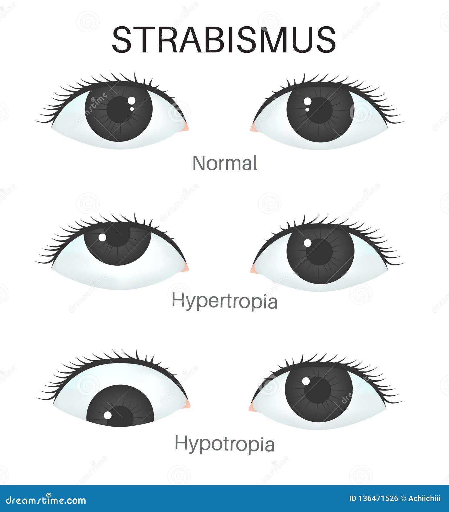 Tipos de strabismus-1 ilustración del vector. Ilustración de diagrama ...