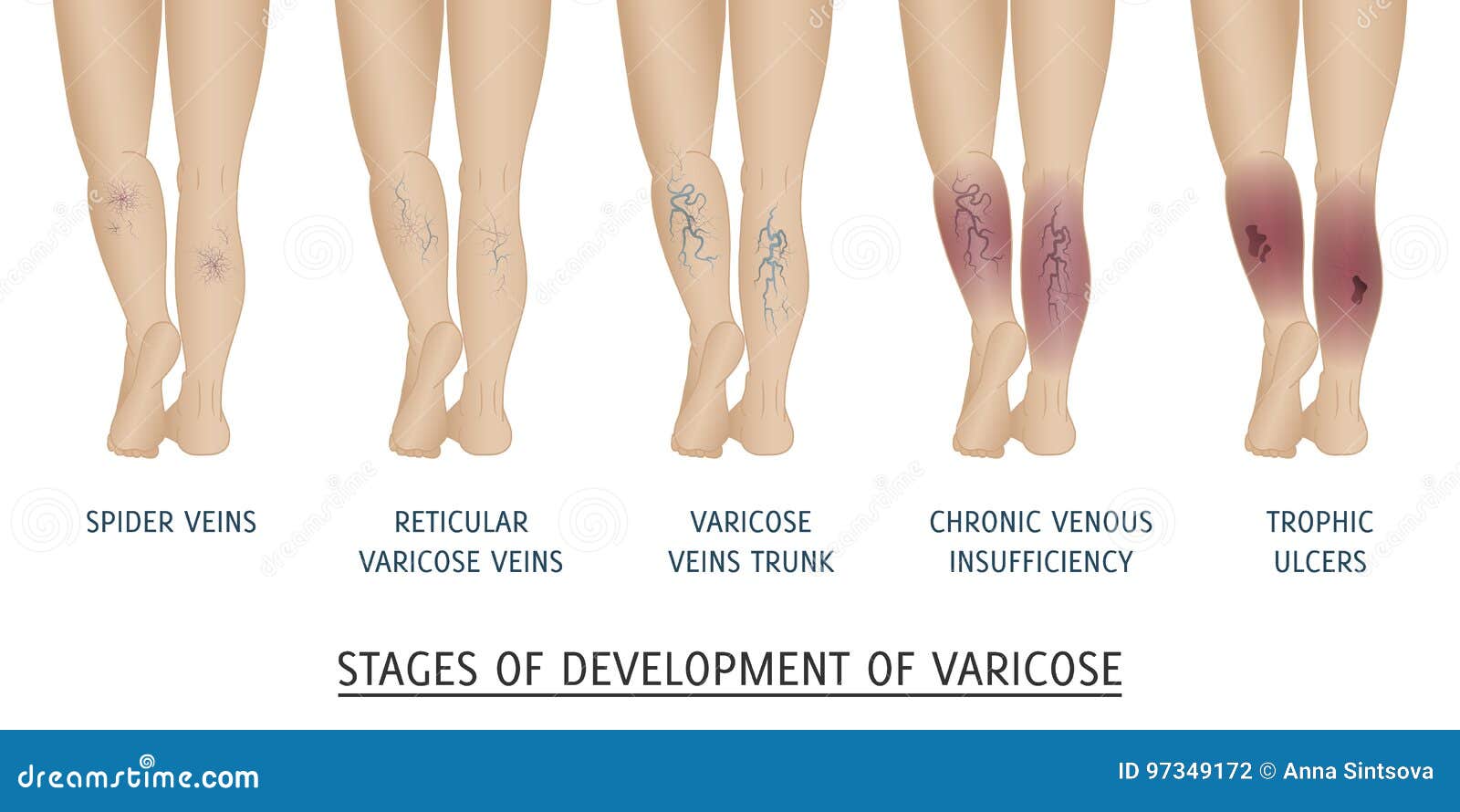 Tipos De Varices En Mujeres Ilustración del Vector - Ilustración de ...