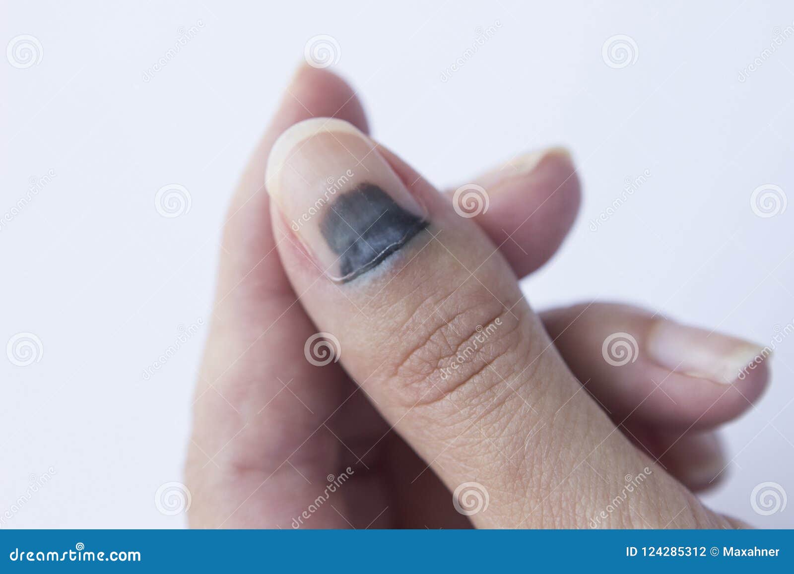 Tiro Horizontal Do Dedo Ferido Do Polegar Com Hematoma Foto de Stock ...