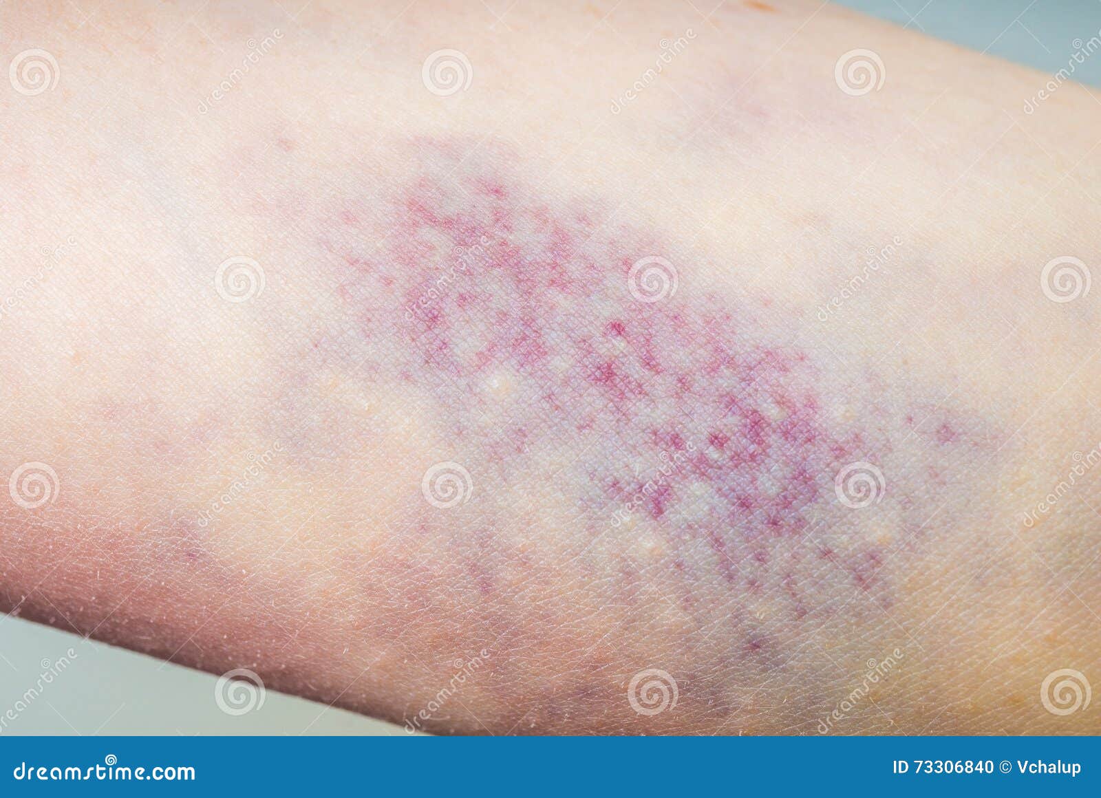 Equimose Na Pele Stock Photos - Royalty Free Images